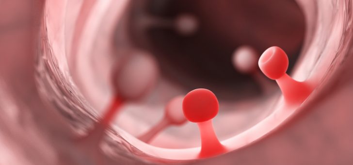 Types of polyps and what to do about them | YourLifeChoices