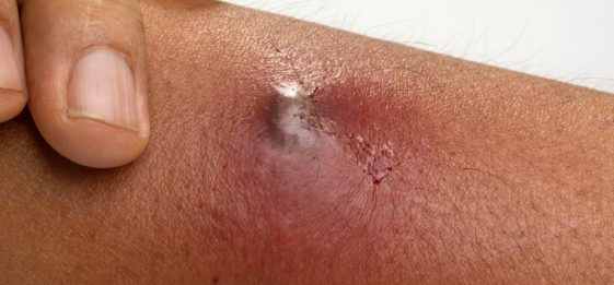 How to spot an abscess and what to do about it | YourLifeChoices