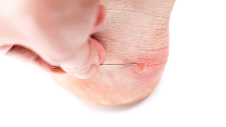 Should you ever pop a blister? | YourLifeChoices