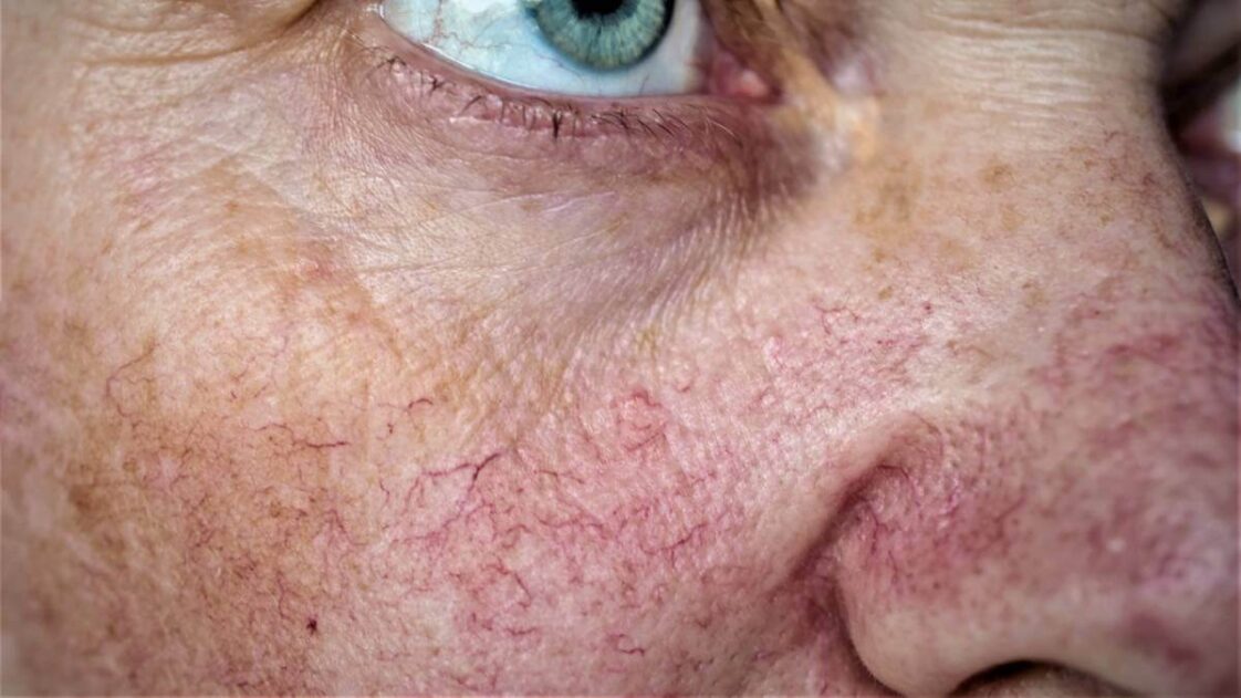 How to fix spider veins on your face | YourLifeChoices