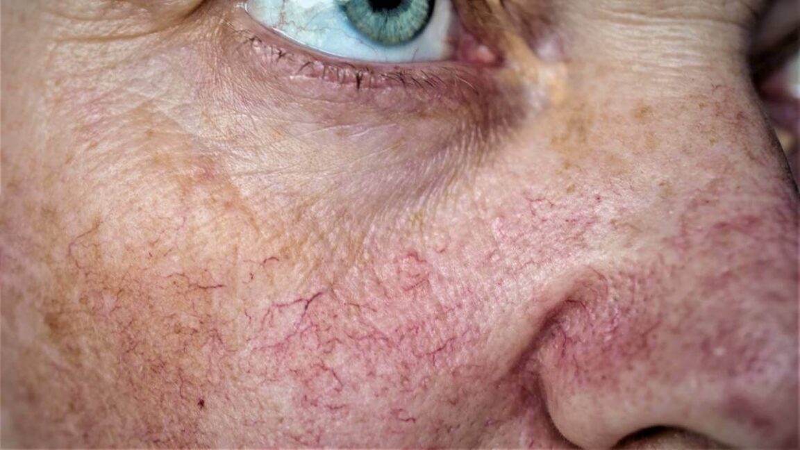 How to fix spider veins on your face | YourLifeChoices