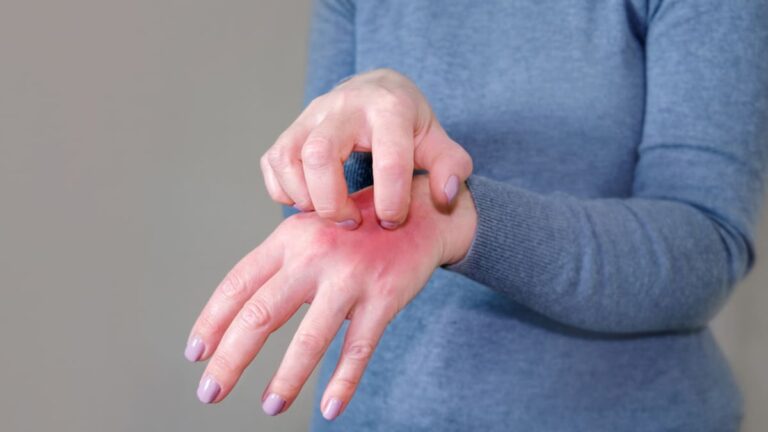 Scabies: what to know about the outbreak of this contagious skin ...