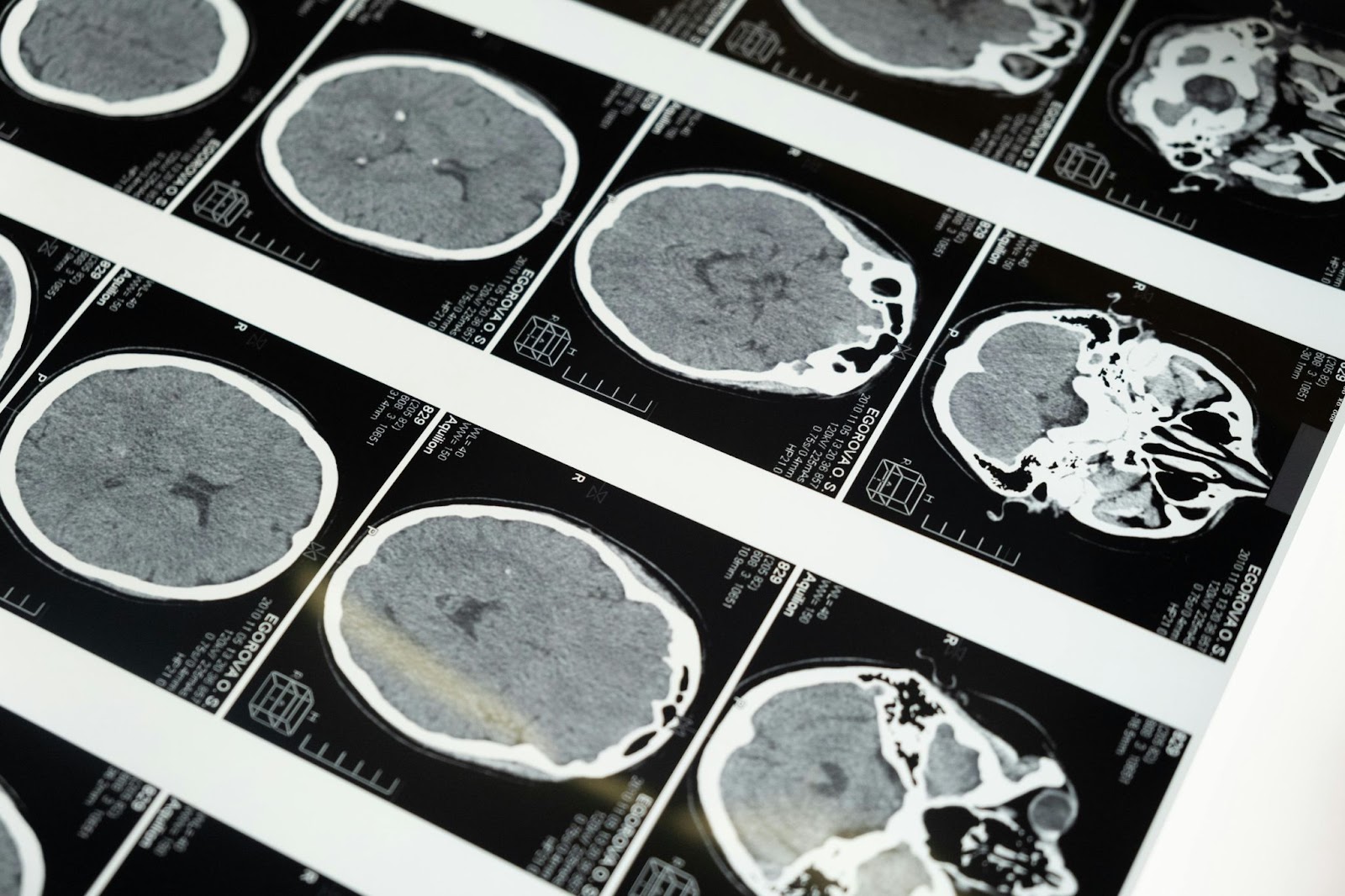 Dementia breakthrough: More cases could be treatable, experts say ...