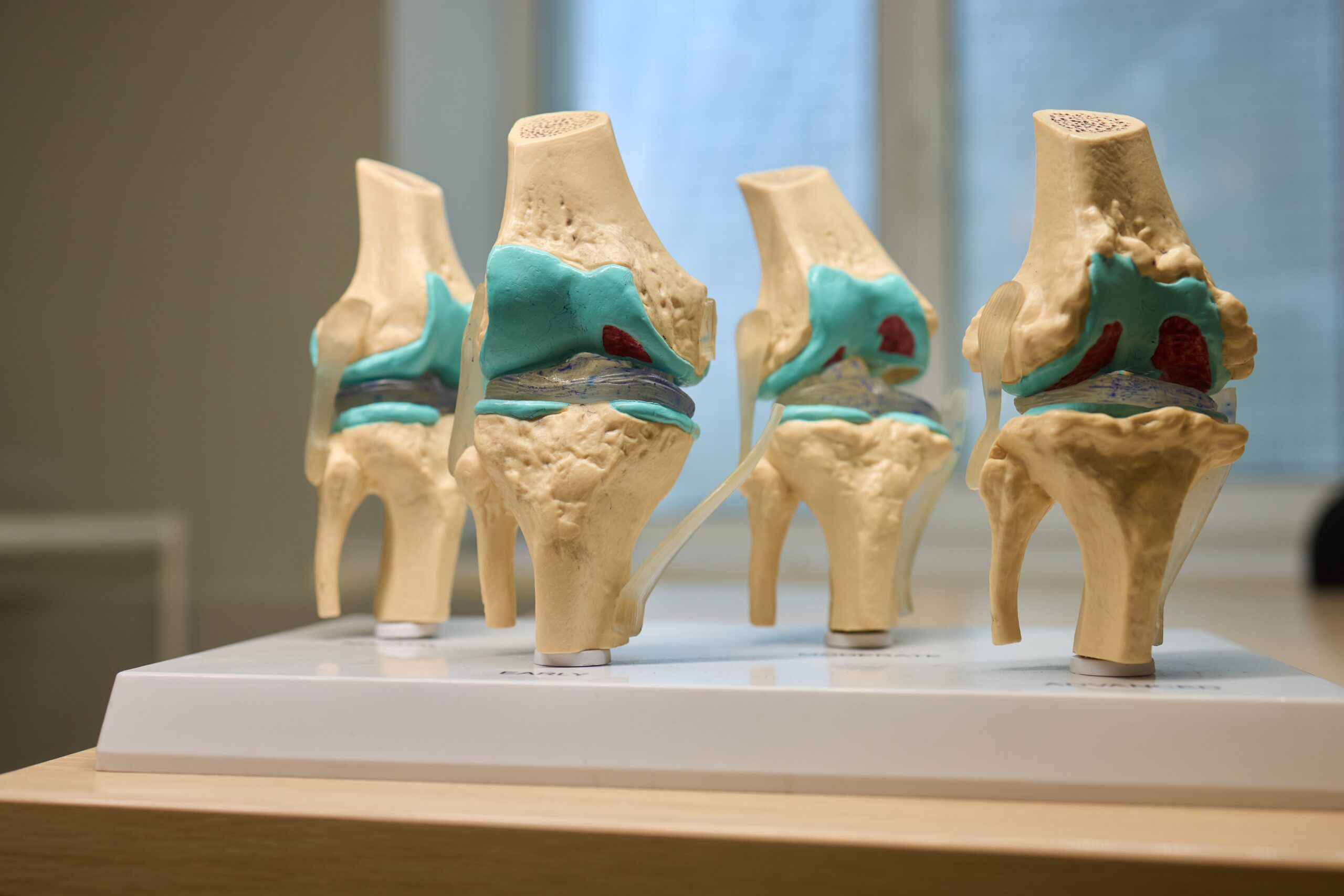 Fracture risks differ across common bone-strengthening treatments ...