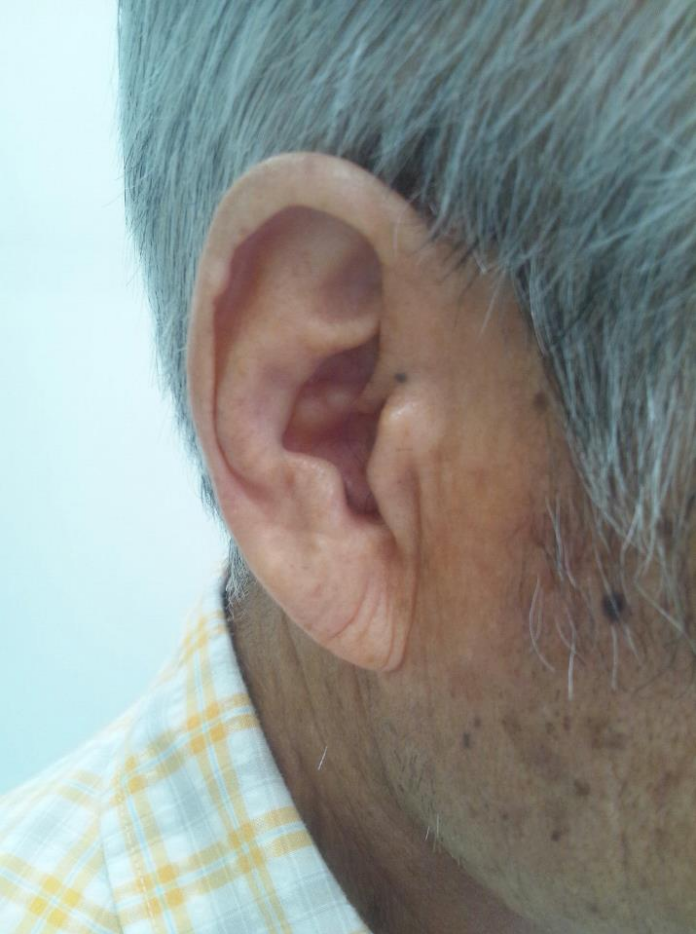 Could a tiny crease on your earlobe be a warning sign for heart disease ...